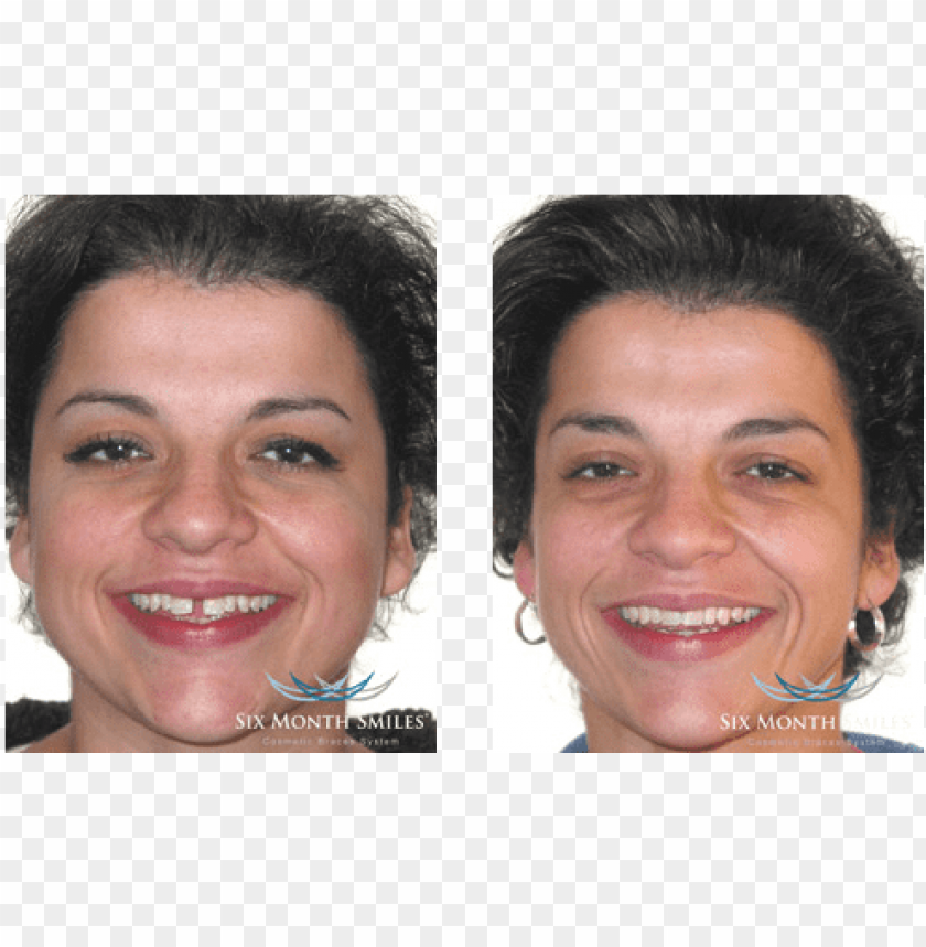 Free download | HD PNG 6 month smiles gaps PNG transparent with Clear ...
