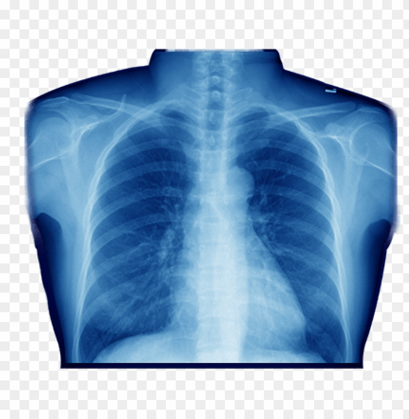 Free download | HD PNG x ray of chest PNG transparent with Clear ...